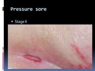 Pressure sore | PPTX