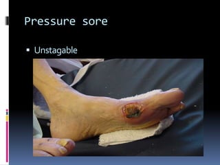 Pressure sore | PPTX