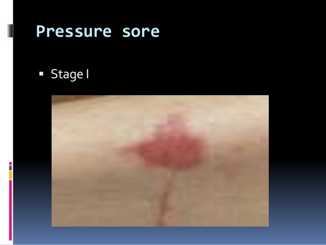 Pressure sore