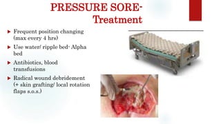 PRESSURE SORE/BED SORE/DECUBITUS ULCER | PPTX