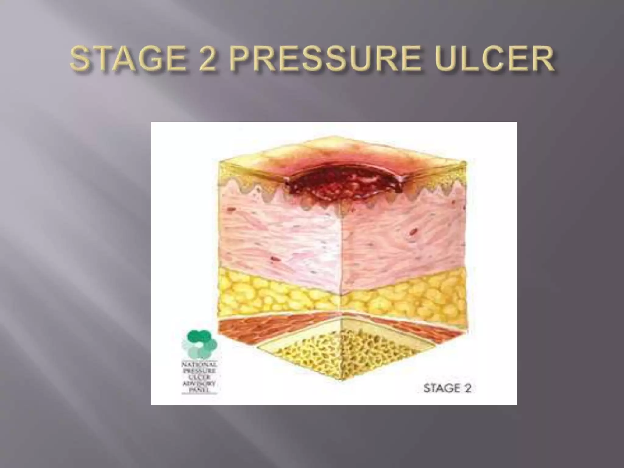 Pressure sore | PPTX