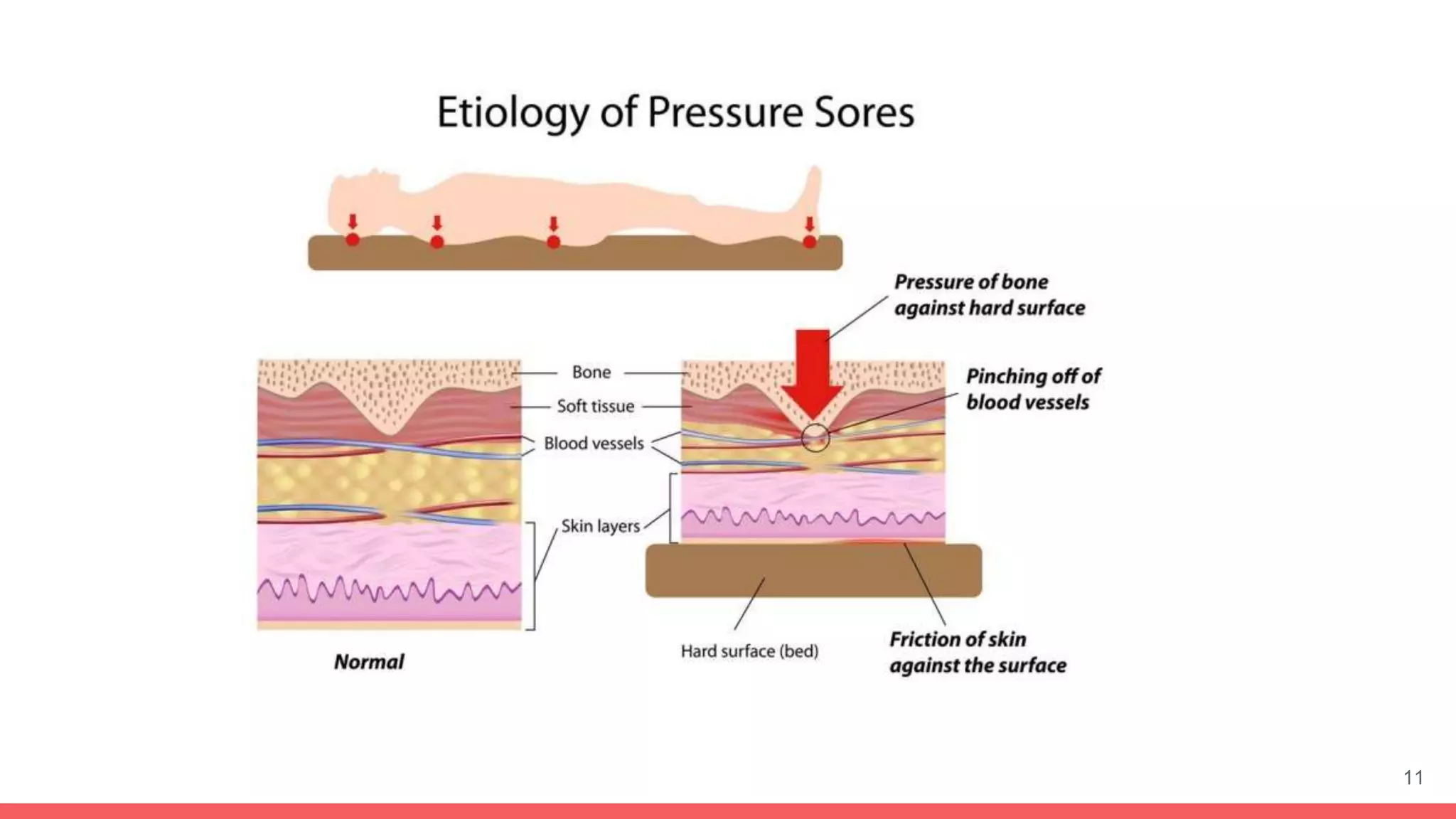 Pressure sore | PPTX