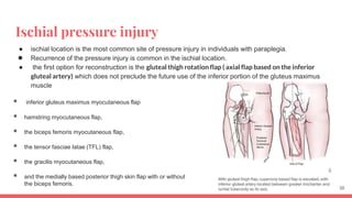 Ischial Pressure Ulcer Icd 9