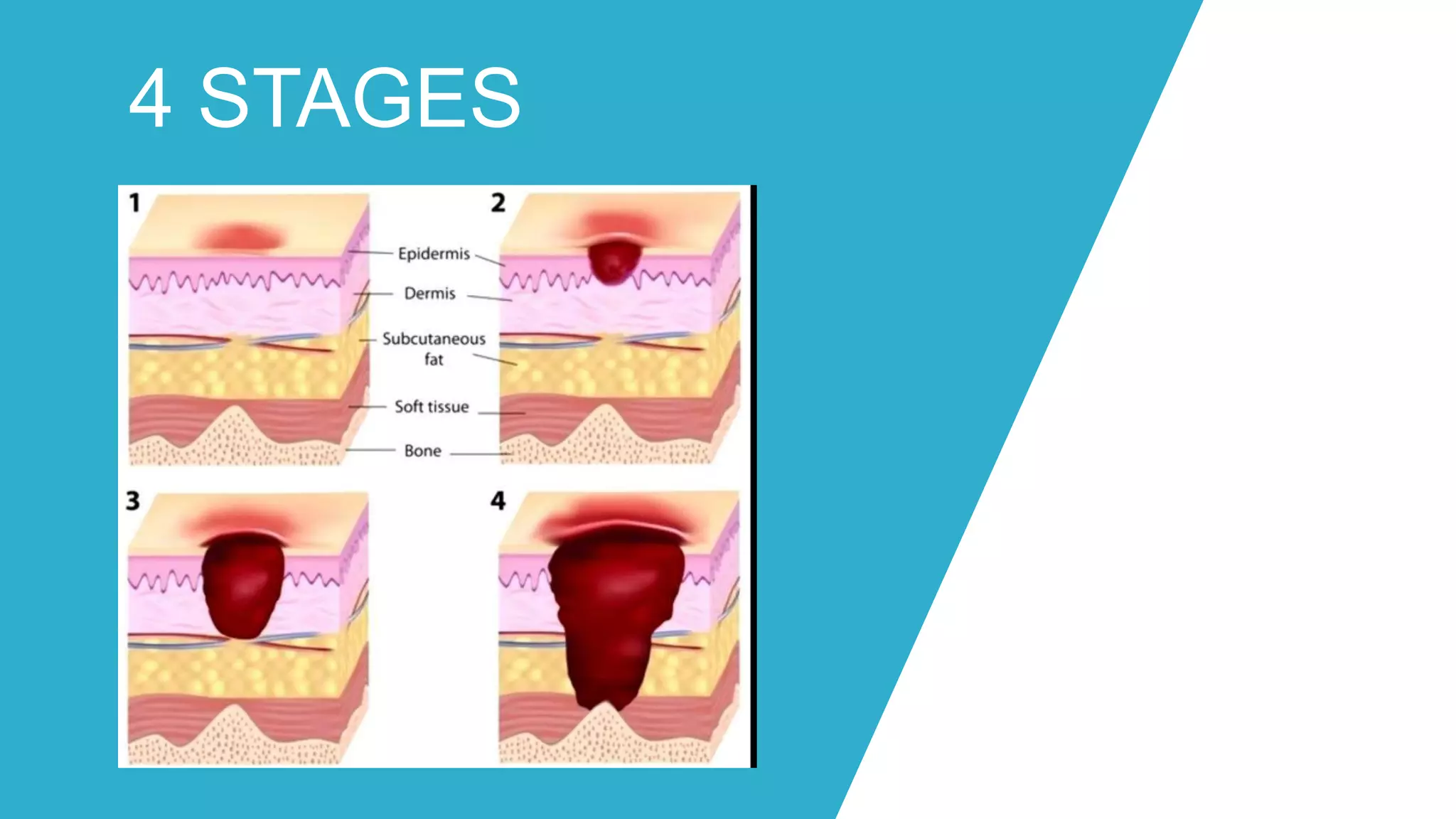PRESSURE SORE ASSESSMENT.pptx