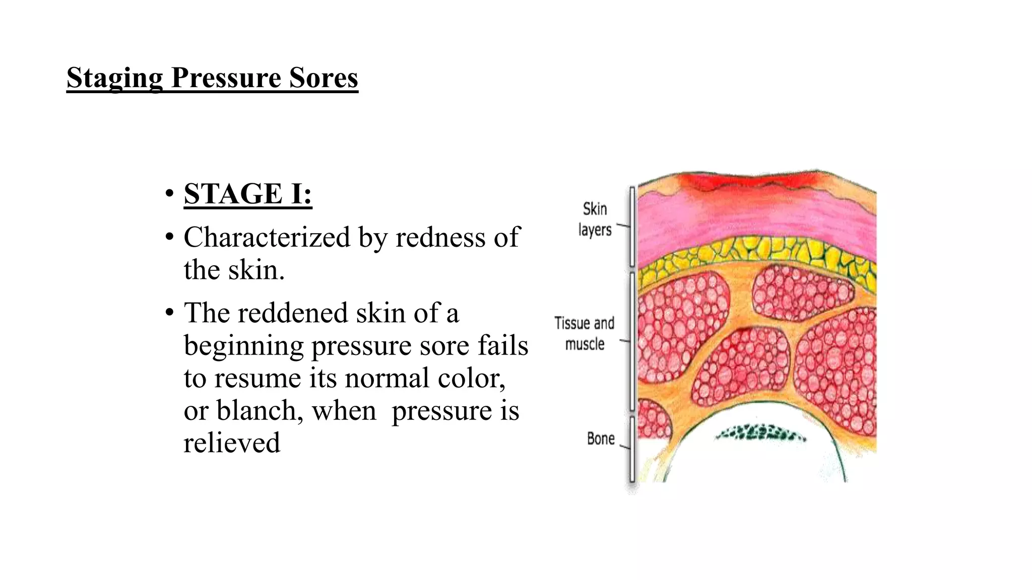 Pressure sore kk 29.pptx