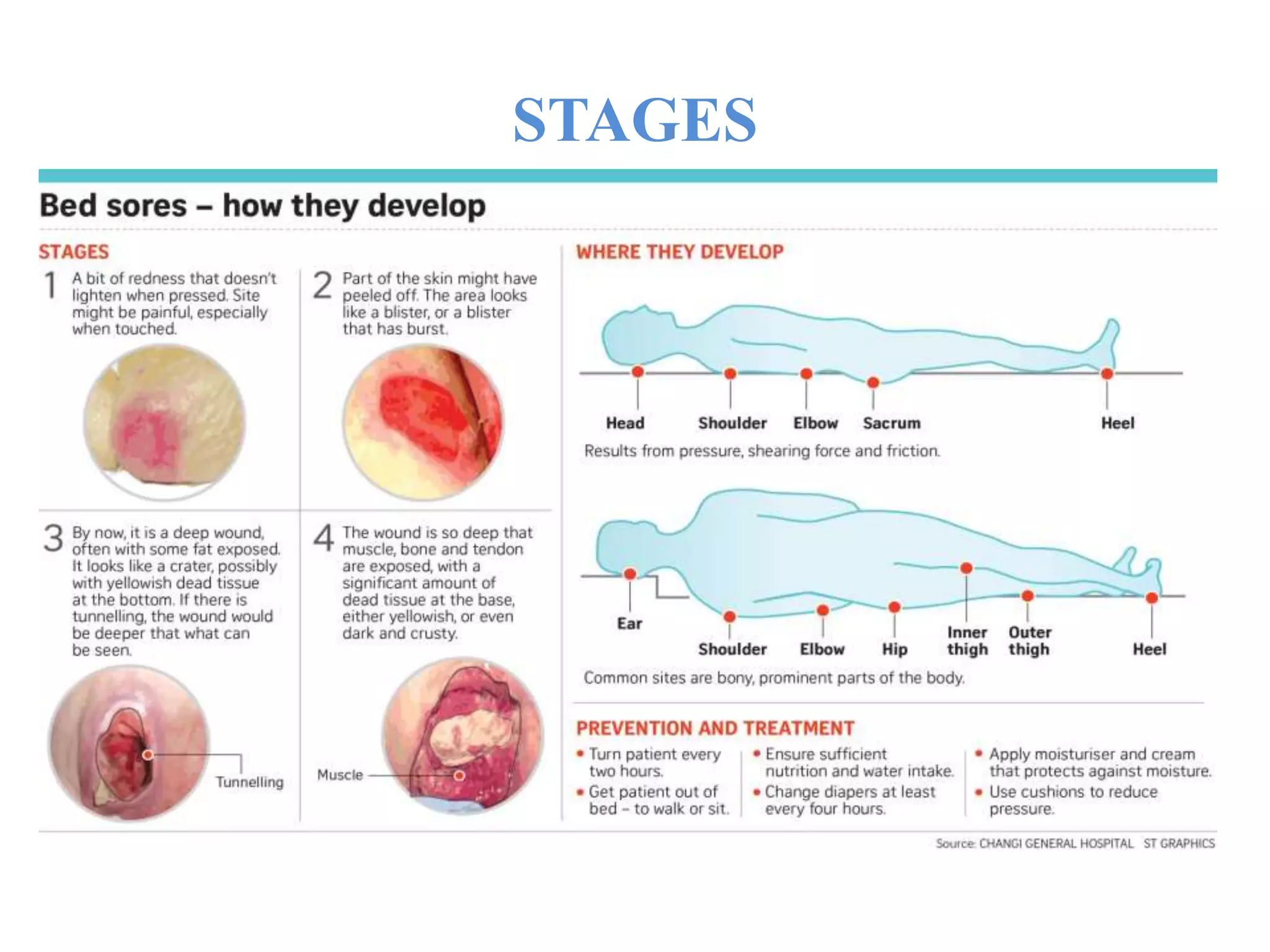 Pressure sore or bed sore or decubitus ulcer ppt | PPTX