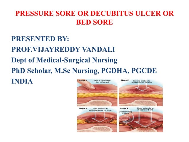 Pressure sore or bed sore or decubitus ulcer ppt | PPTX | Skin and ...