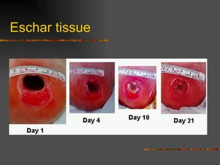 Pressure Sores | PPT