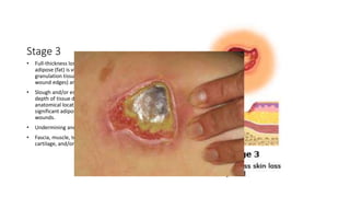 Pressure Sores.pptx