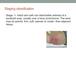 Pressure Sore | PPT