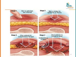 Pressure sores prevention & Risk assessment.pptx