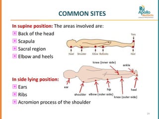 Pressure sores prevention & Risk assessment.pptx