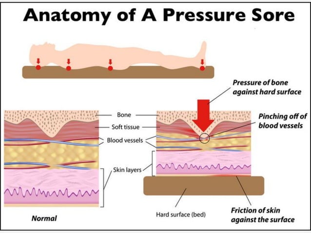Pressure sore diagnosis and management for medical student | PDF