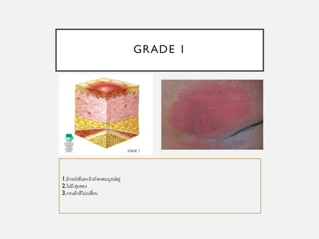 Pressure sore diagnosis and management for medical student | PDF