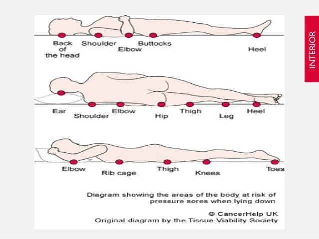 Pressure sore diagnosis and management for medical student