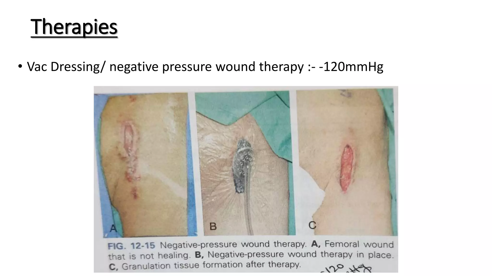 PRESSURE ULCER / BED SORE | PPTX