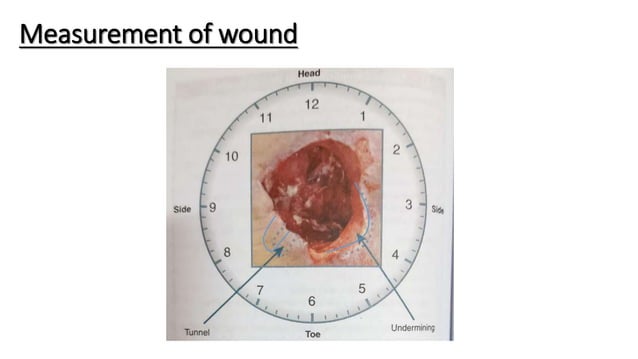 PRESSURE ULCER / BED SORE | PPTX | Skin and Dermatology | Diseases and ...