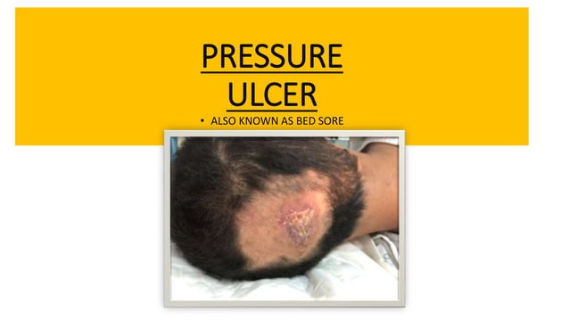 PRESSURE ULCER / BED SORE | PPTX | Skin and Dermatology | Diseases and ...