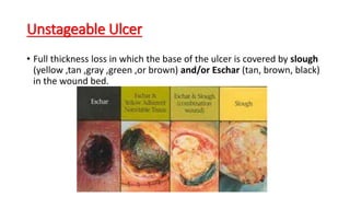 PRESSURE ULCER / BED SORE | PPT