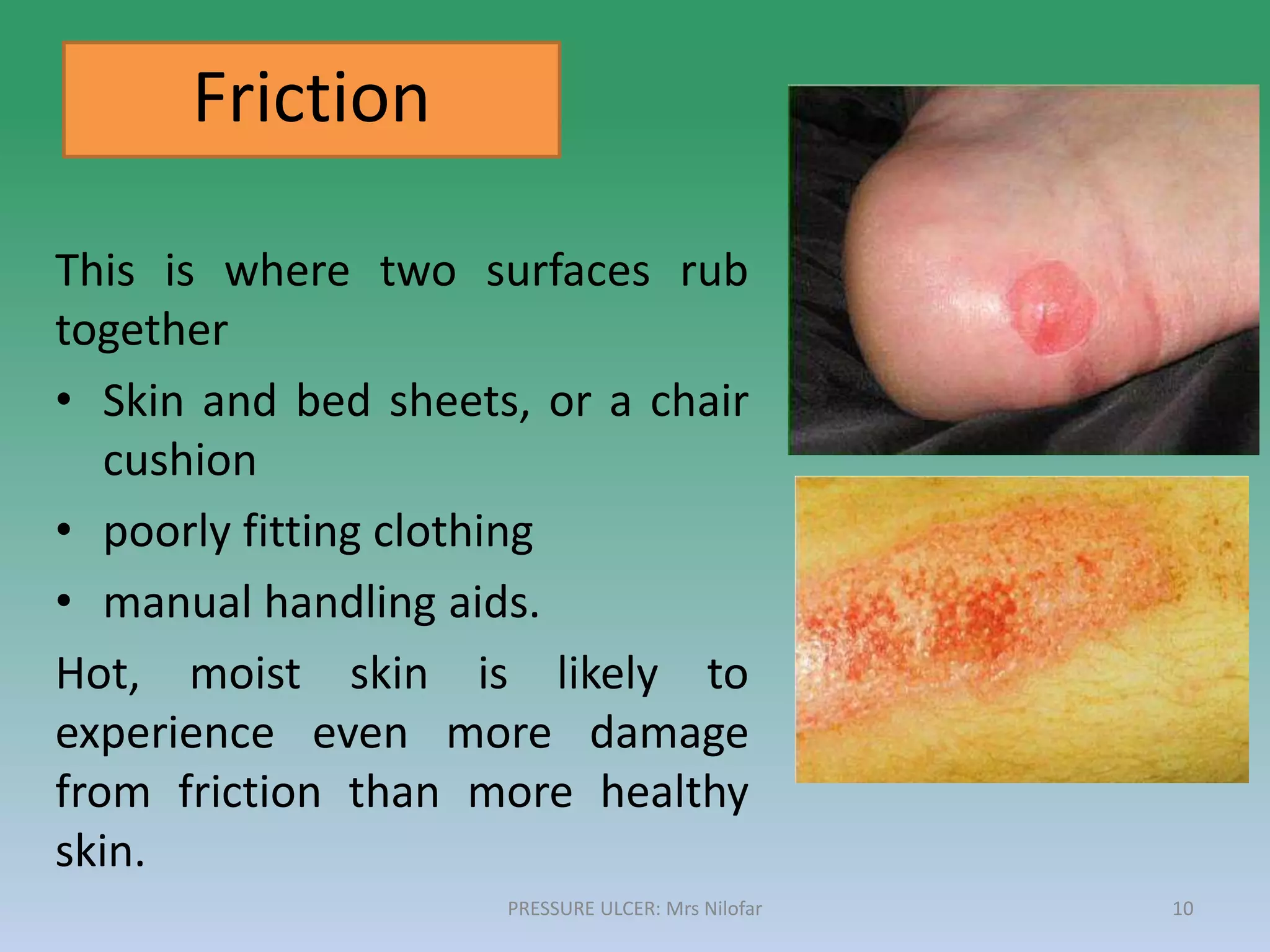 pressure ulcer.pptx