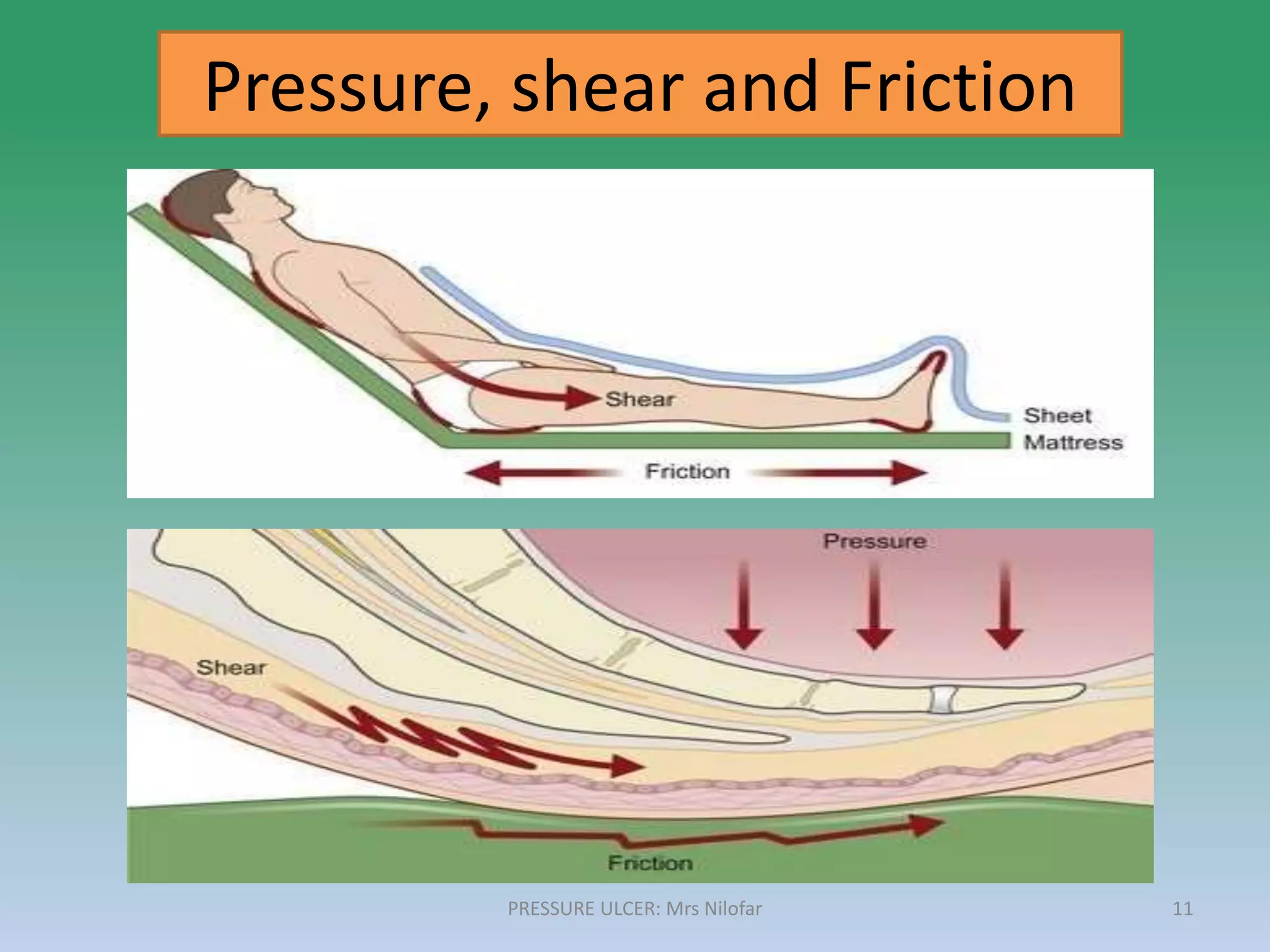 pressure ulcer.pptx