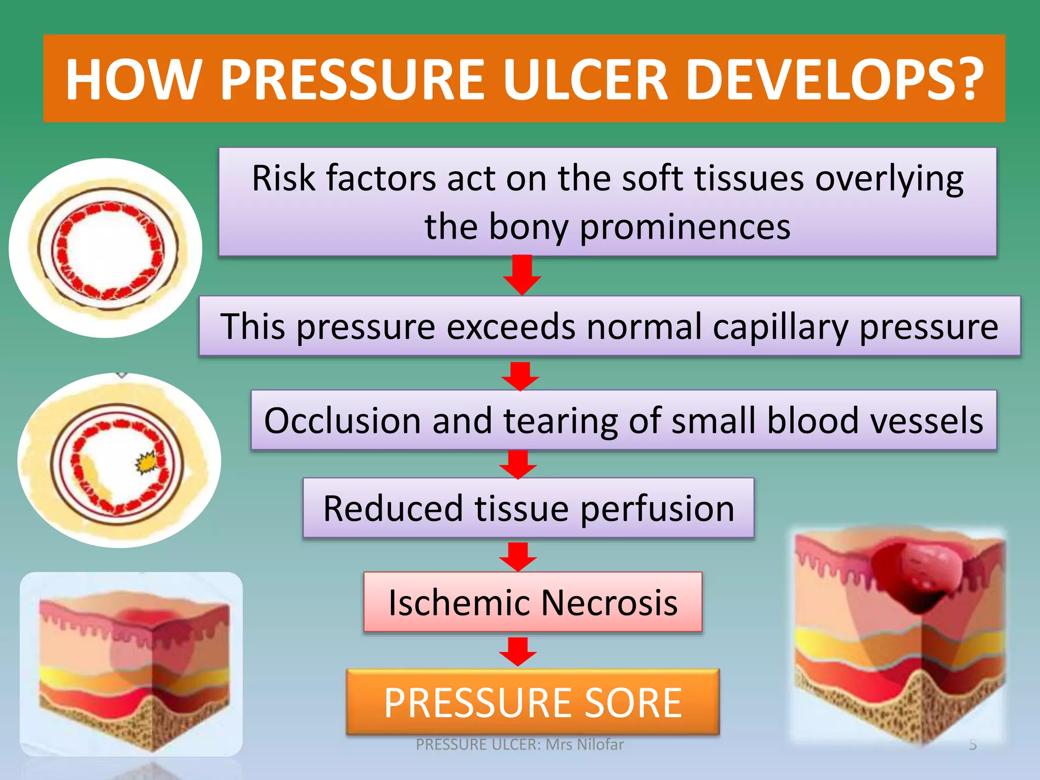 pressure ulcer.pptx