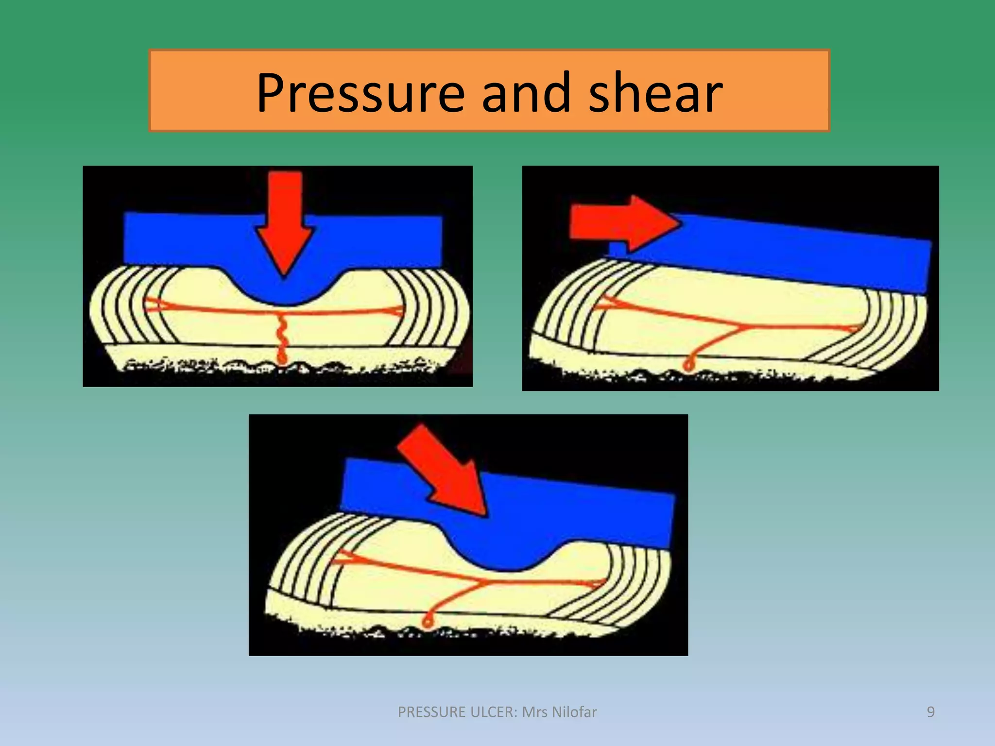pressure ulcer.pptx