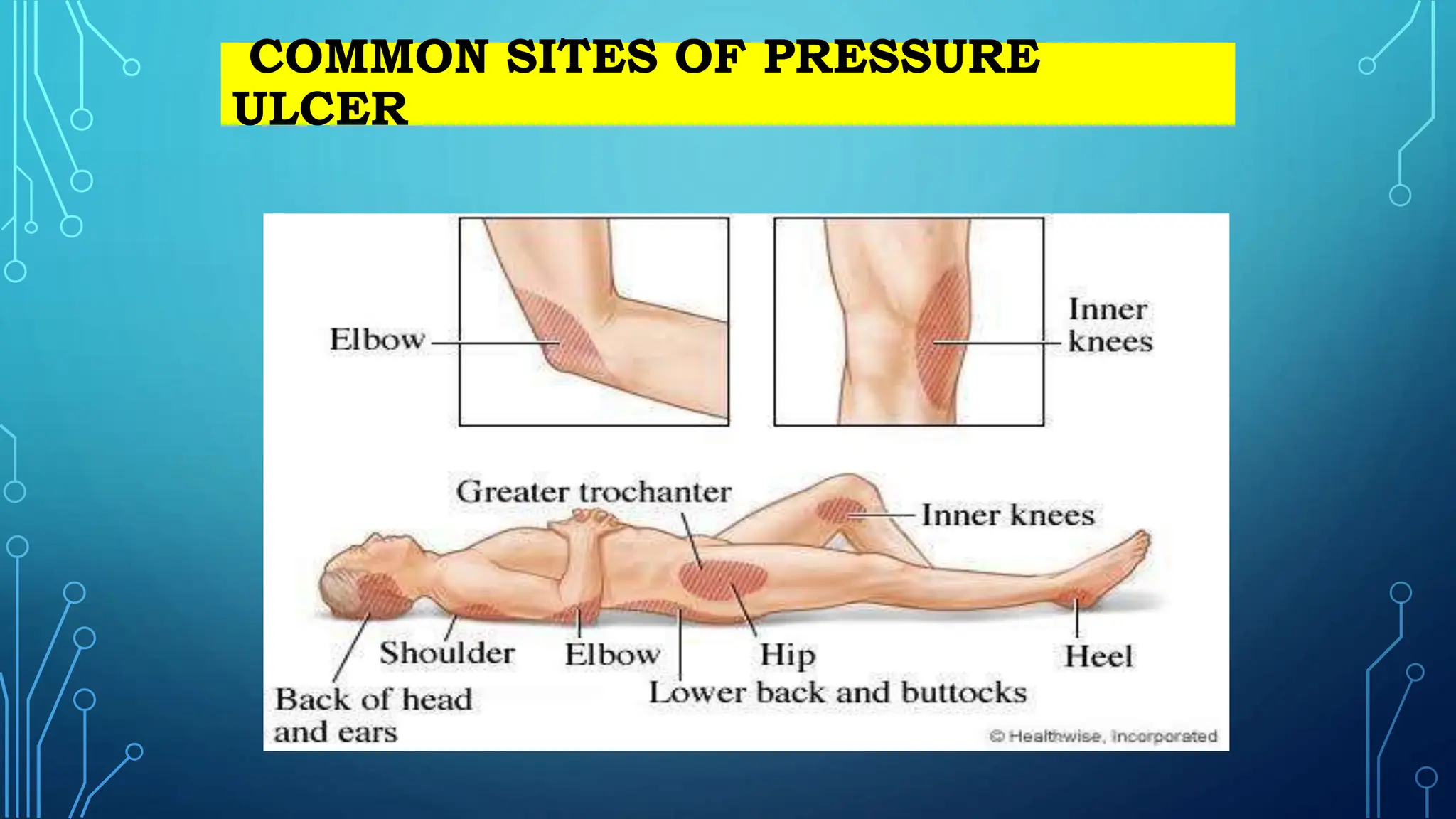 Pressure Ulcer......................pptx