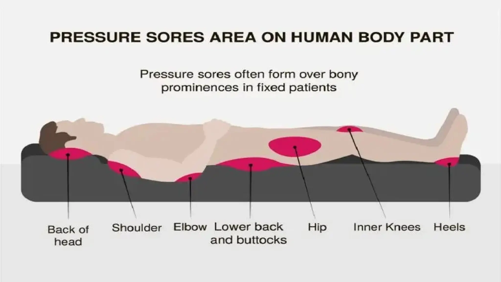 Pressure Ulcer: Stages, Causes, Prevention, and Nursing Management.pptx