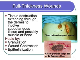 Pressureulcerandwoundsextrahelp | PPT