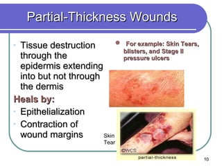 Full Thickness Wound
