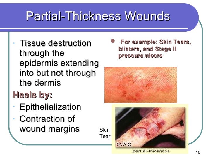 Pressureulcerandwoundsextrahelp