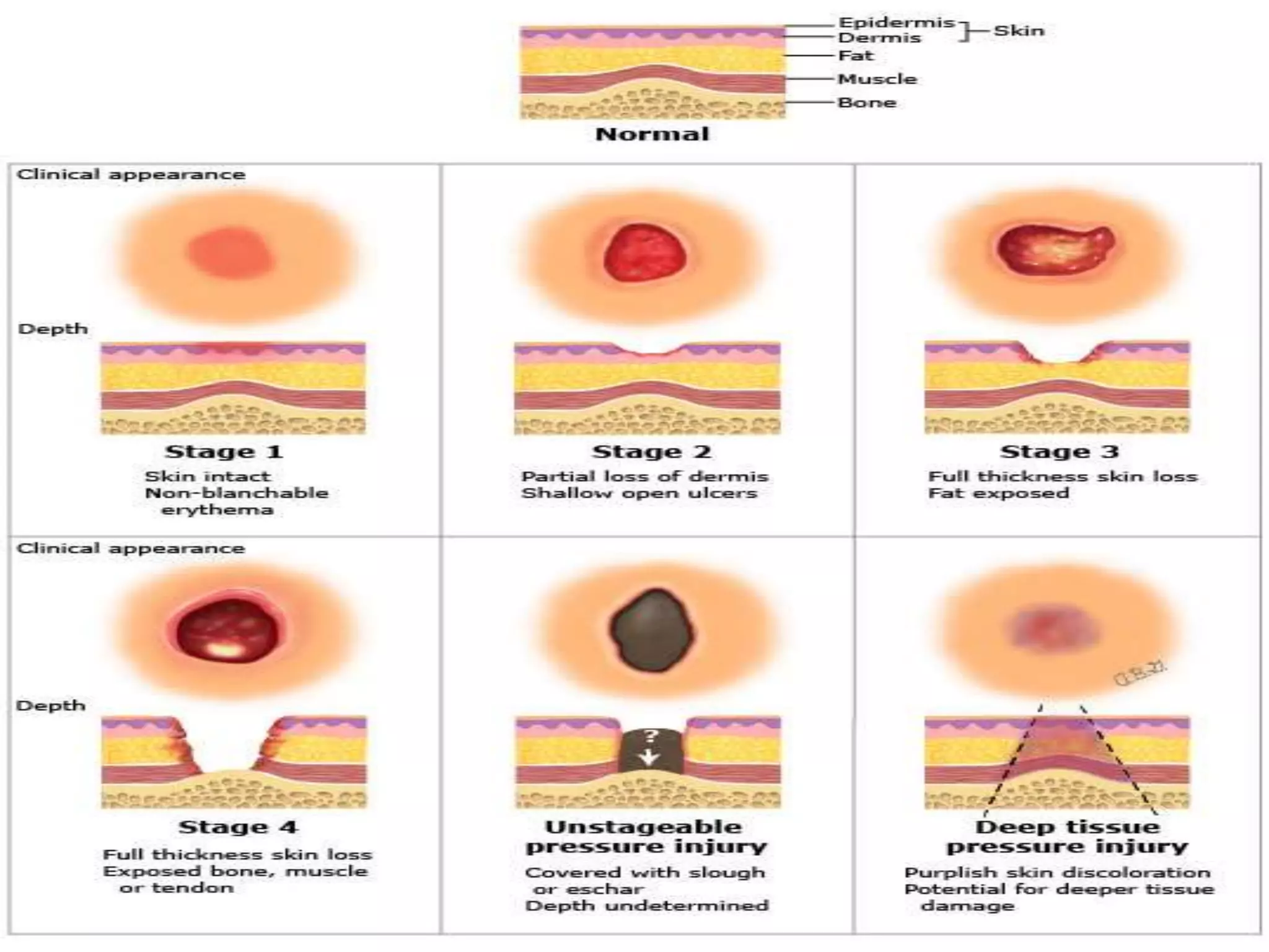Pressure Ulcer Assessment Prevention And Reporting Ppt