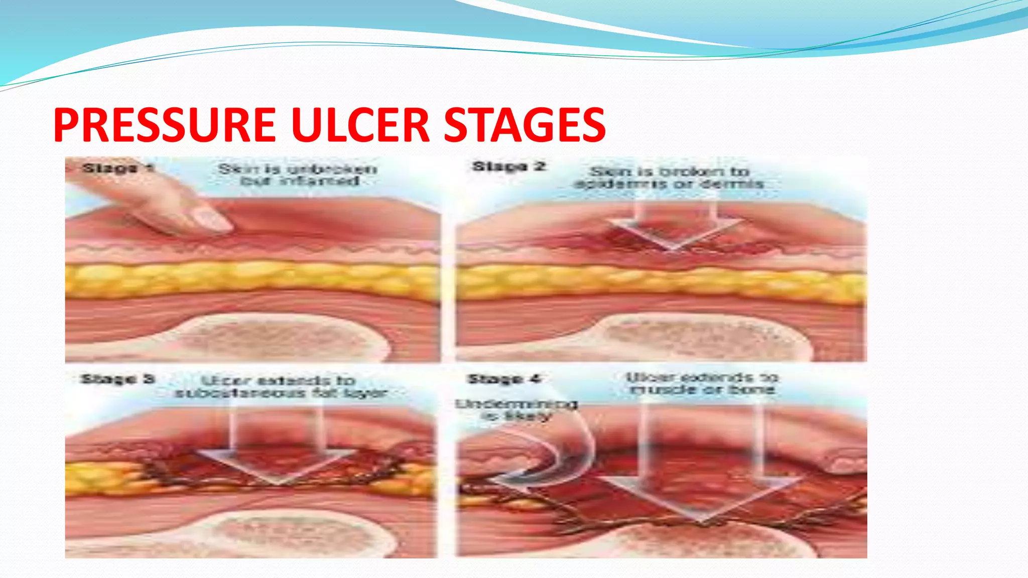 Pressure ulcer ppt | PPTX