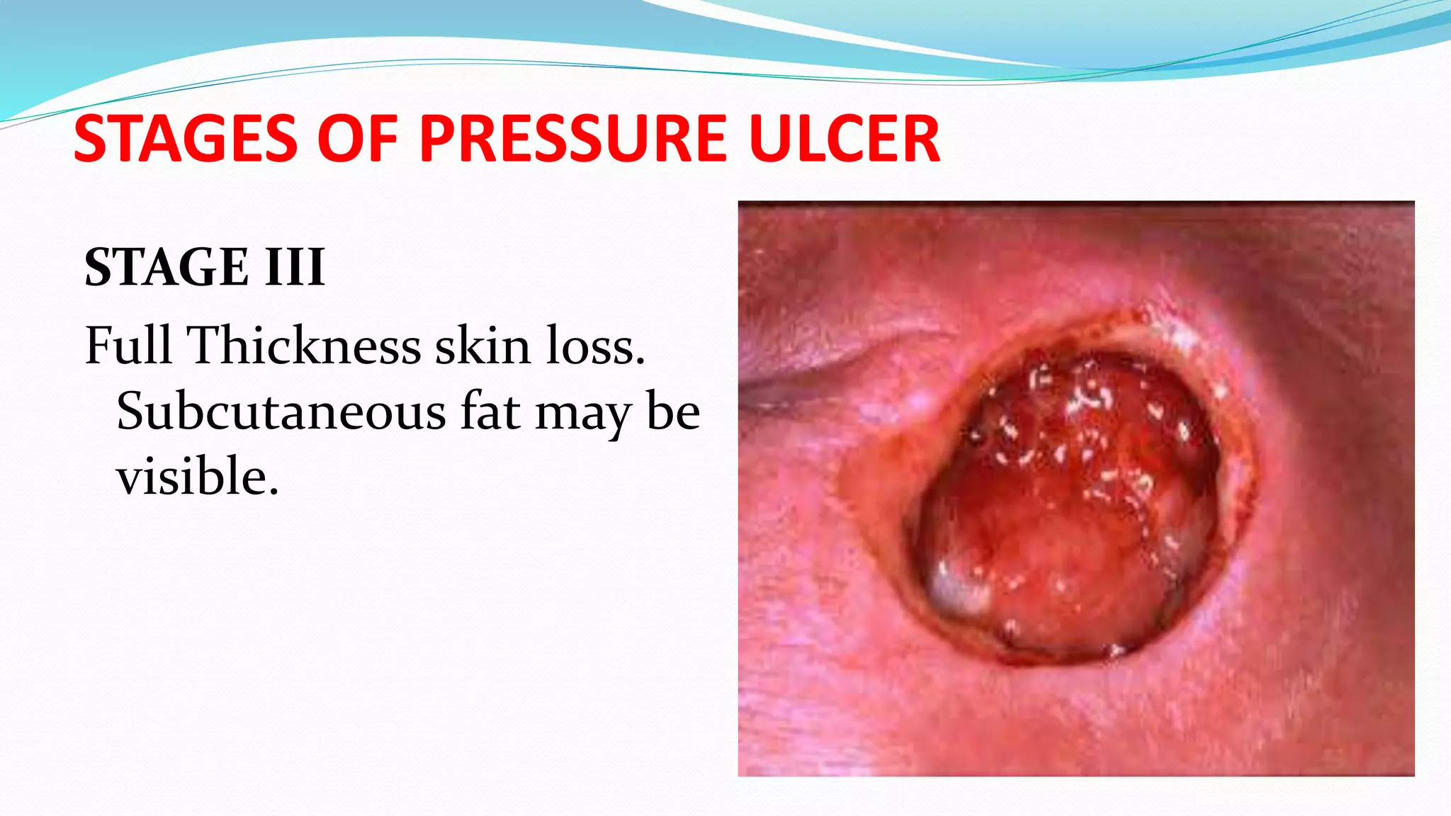 Pressure ulcer ppt | PPTX