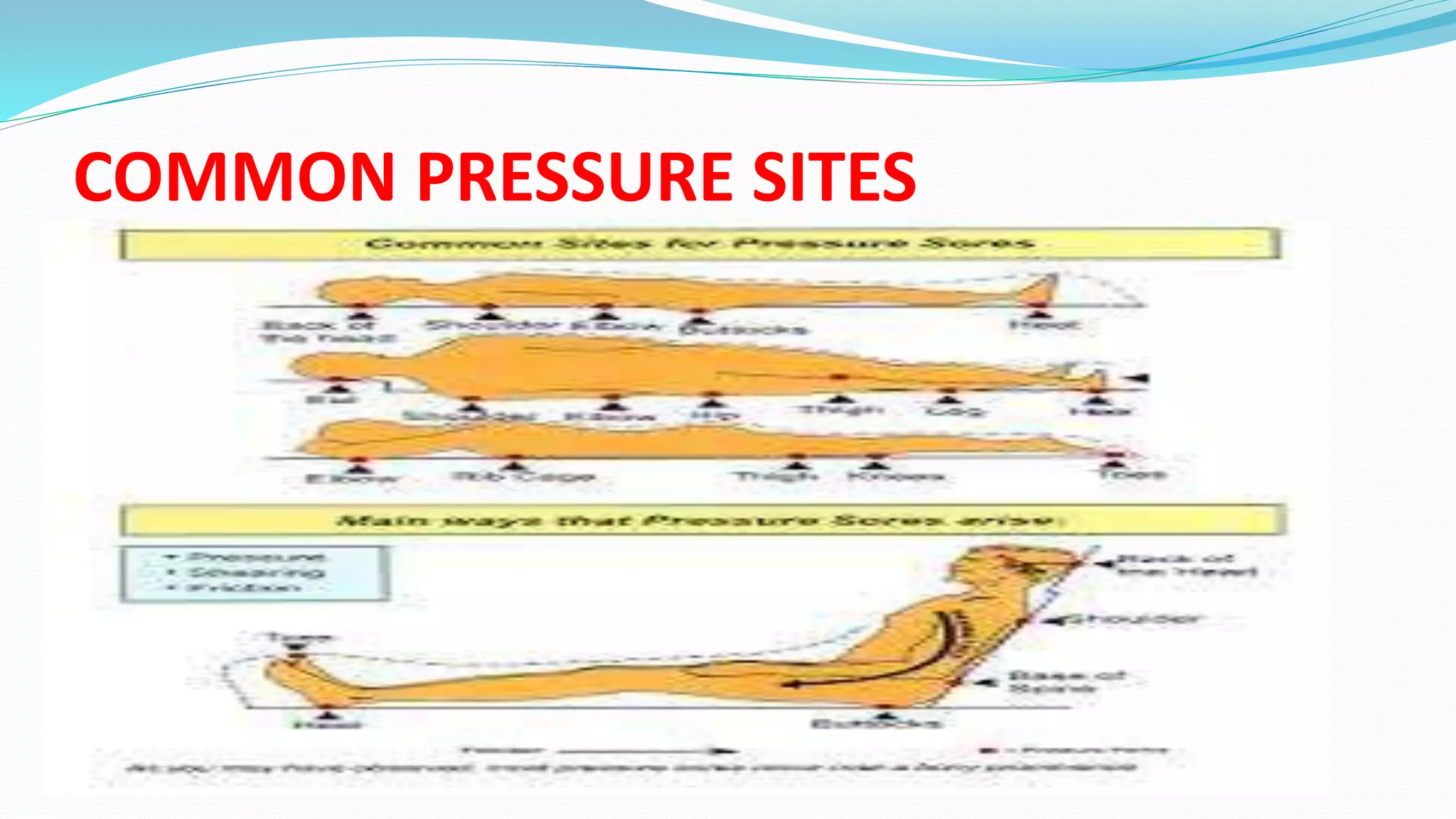 Pressure ulcer ppt | PPTX