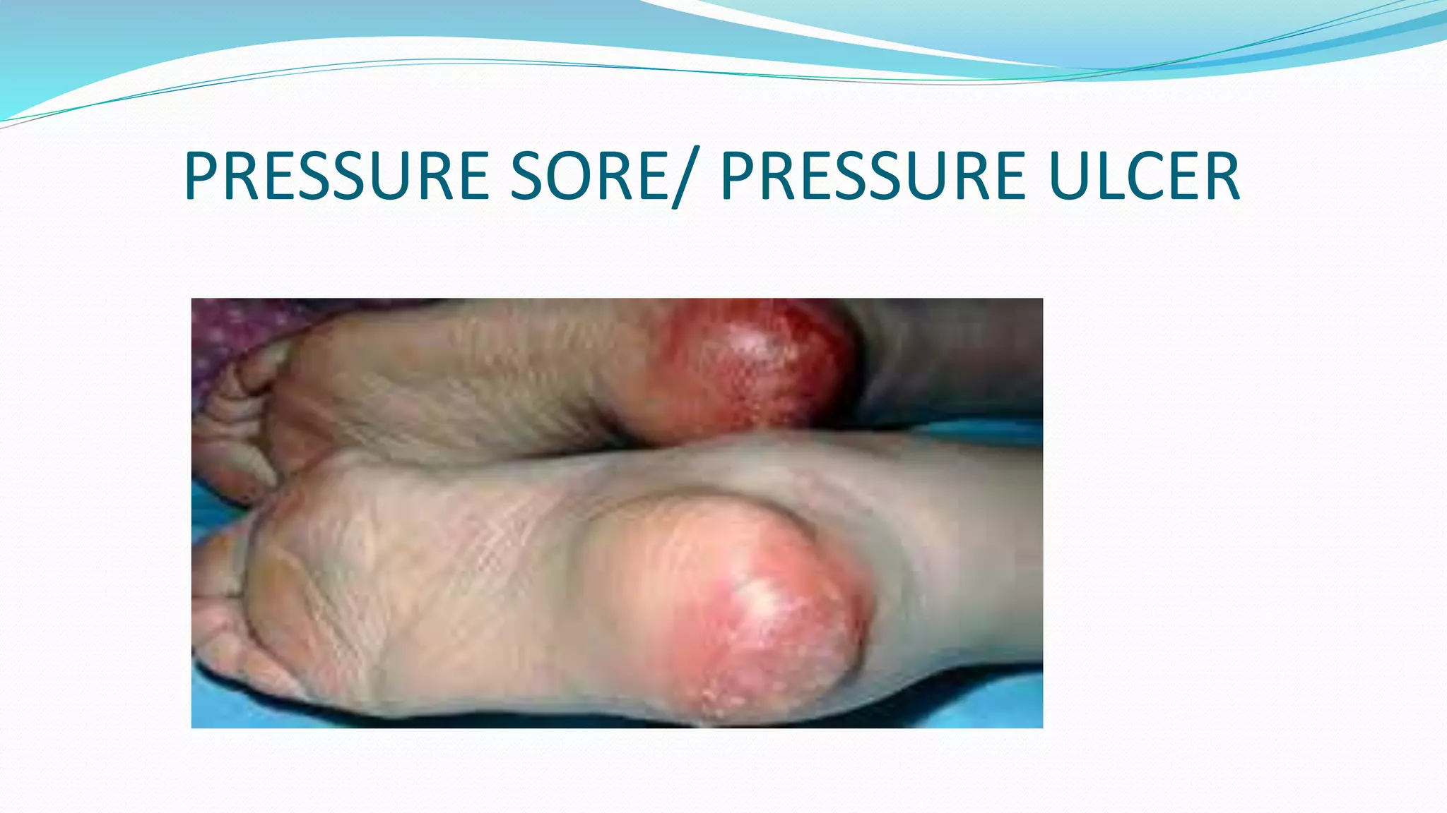 Pressure ulcer ppt | PPTX