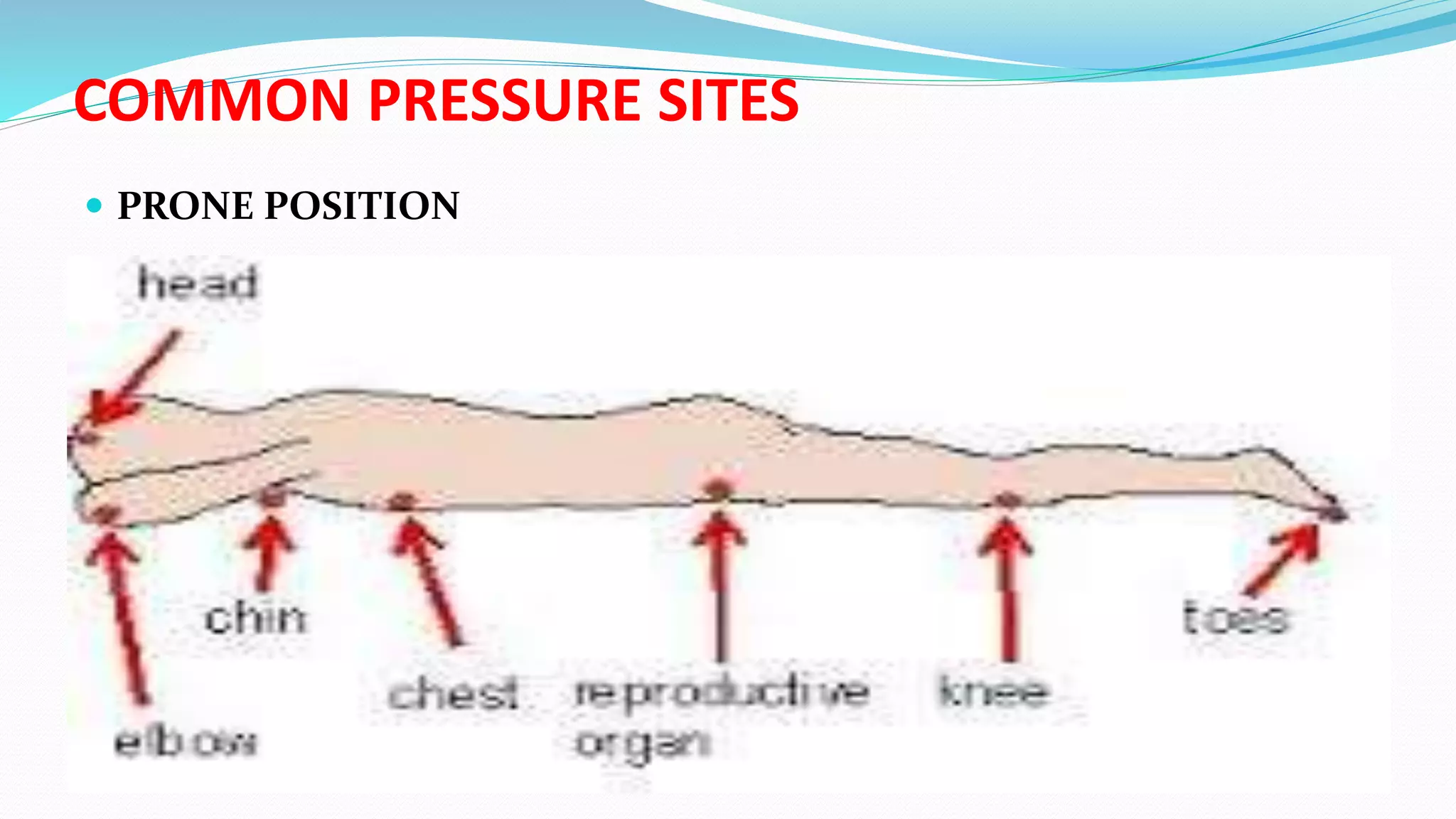 Pressure ulcer ppt | PPTX