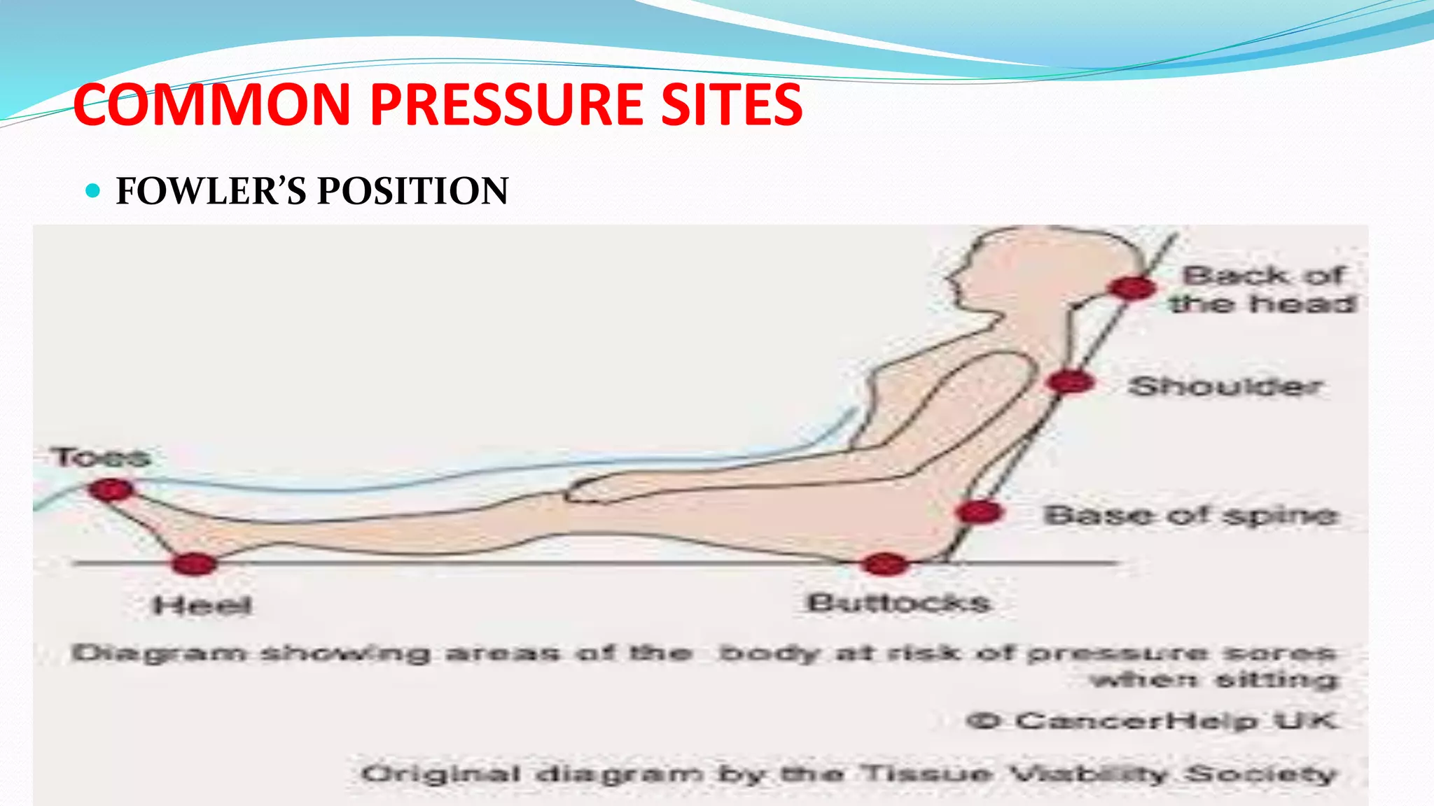 Pressure ulcer ppt | PPTX