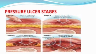 Pressure Ulcer Ppt Pptx