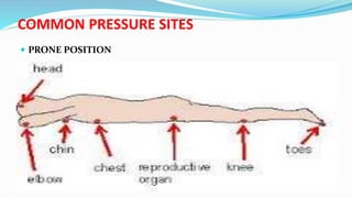 Pressure ulcer ppt | PPTX