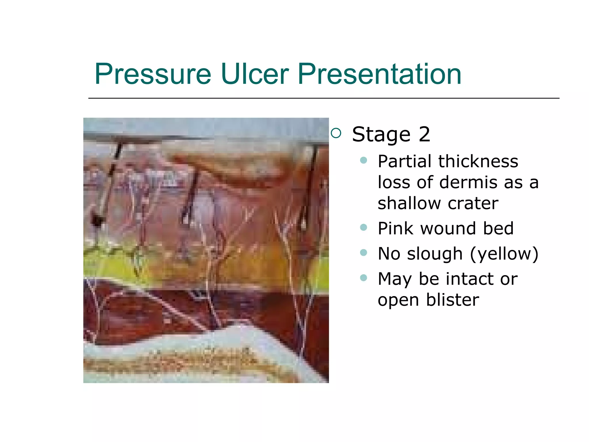 Pressure ulcer presentation3 | PPT