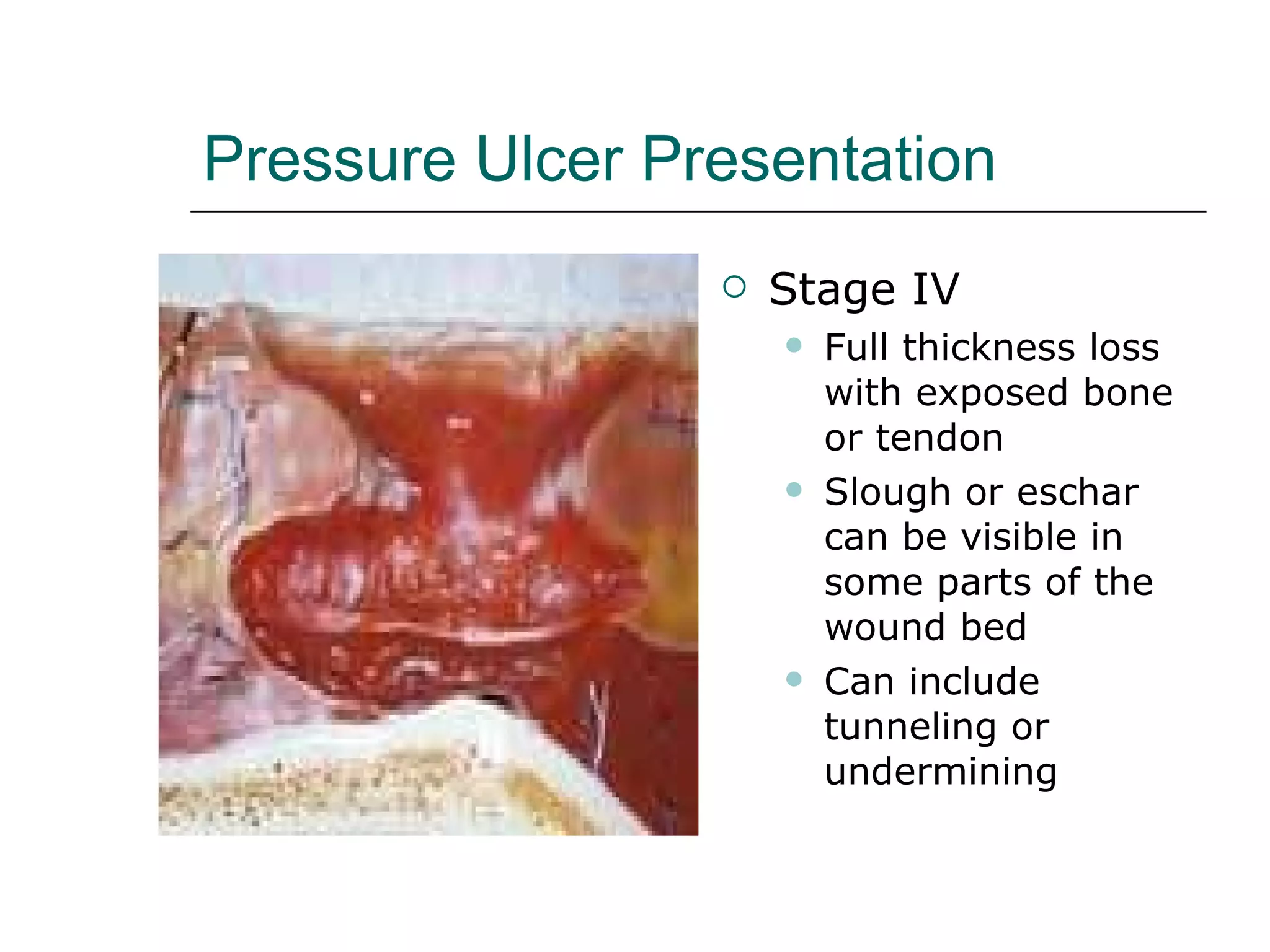 Pressure ulcer presentation3 | PPT