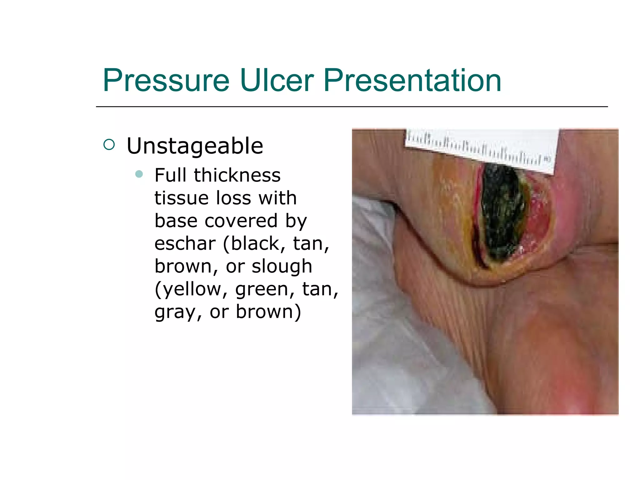 Pressure ulcer presentation3 | PPT