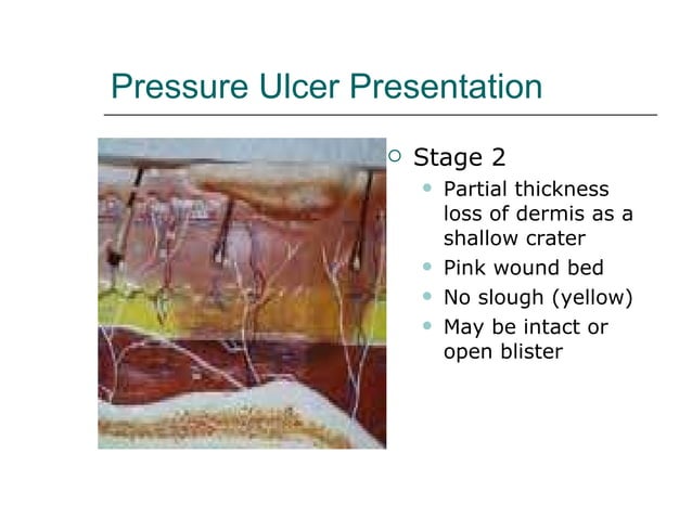 Pressure ulcer presentation3 | PPT | First Aid | Injuries