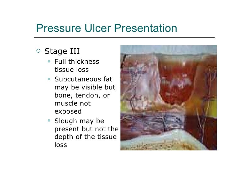 Pressure ulcer presentation3