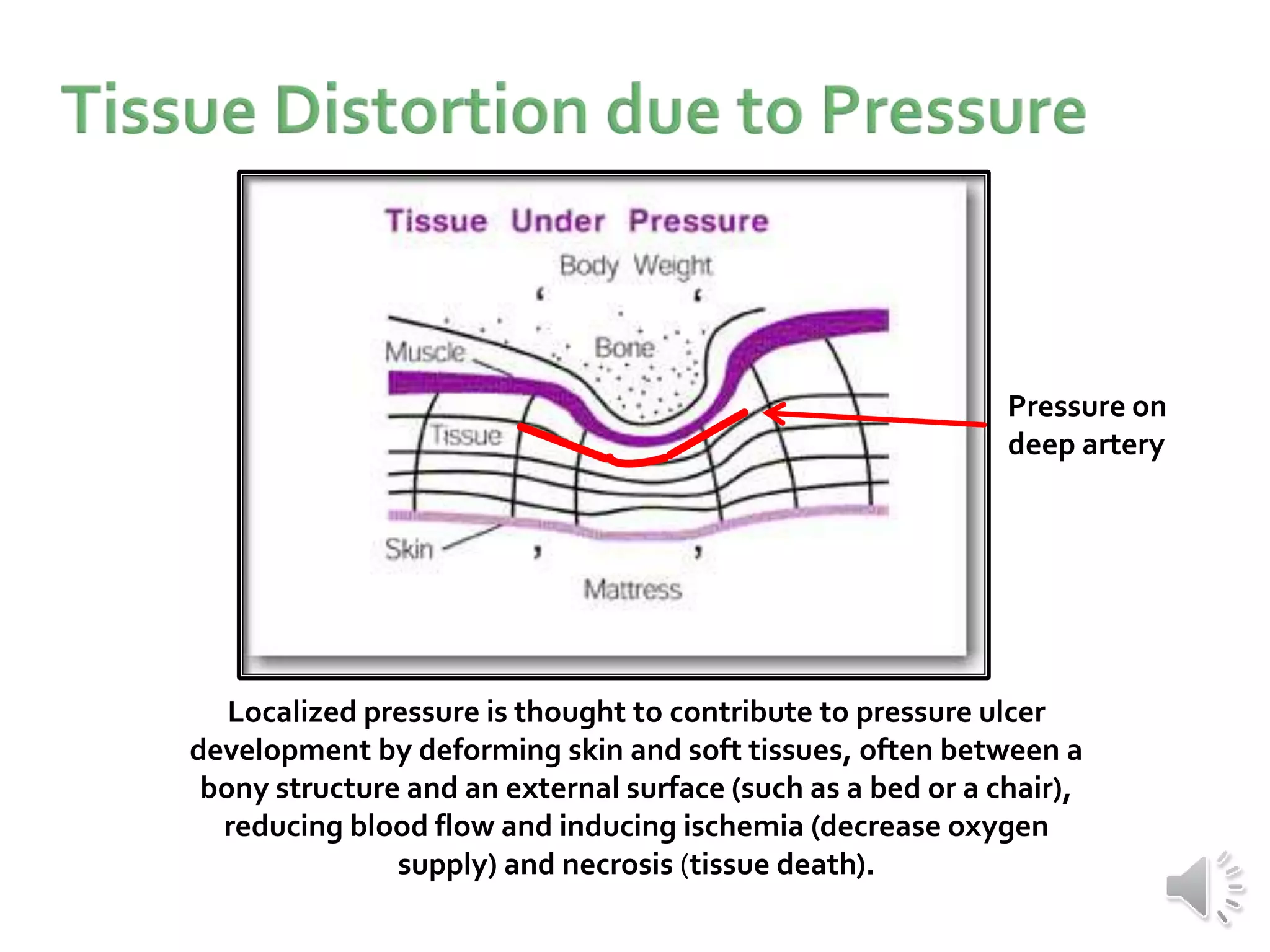 Pressure ulcer prevention[2] | PPTX