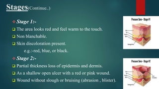 Pressure ulcer prevention and care.pptx