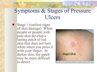 Pressure Ulcer Prevention & Skin Care | PPT