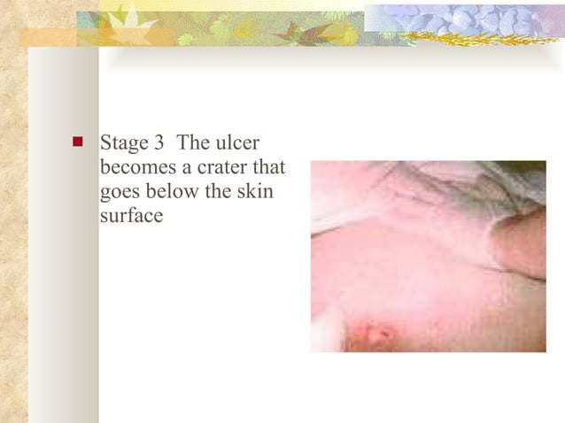 Pressure Ulcer Prevention & Skin Care | PPT | Skin and Dermatology ...